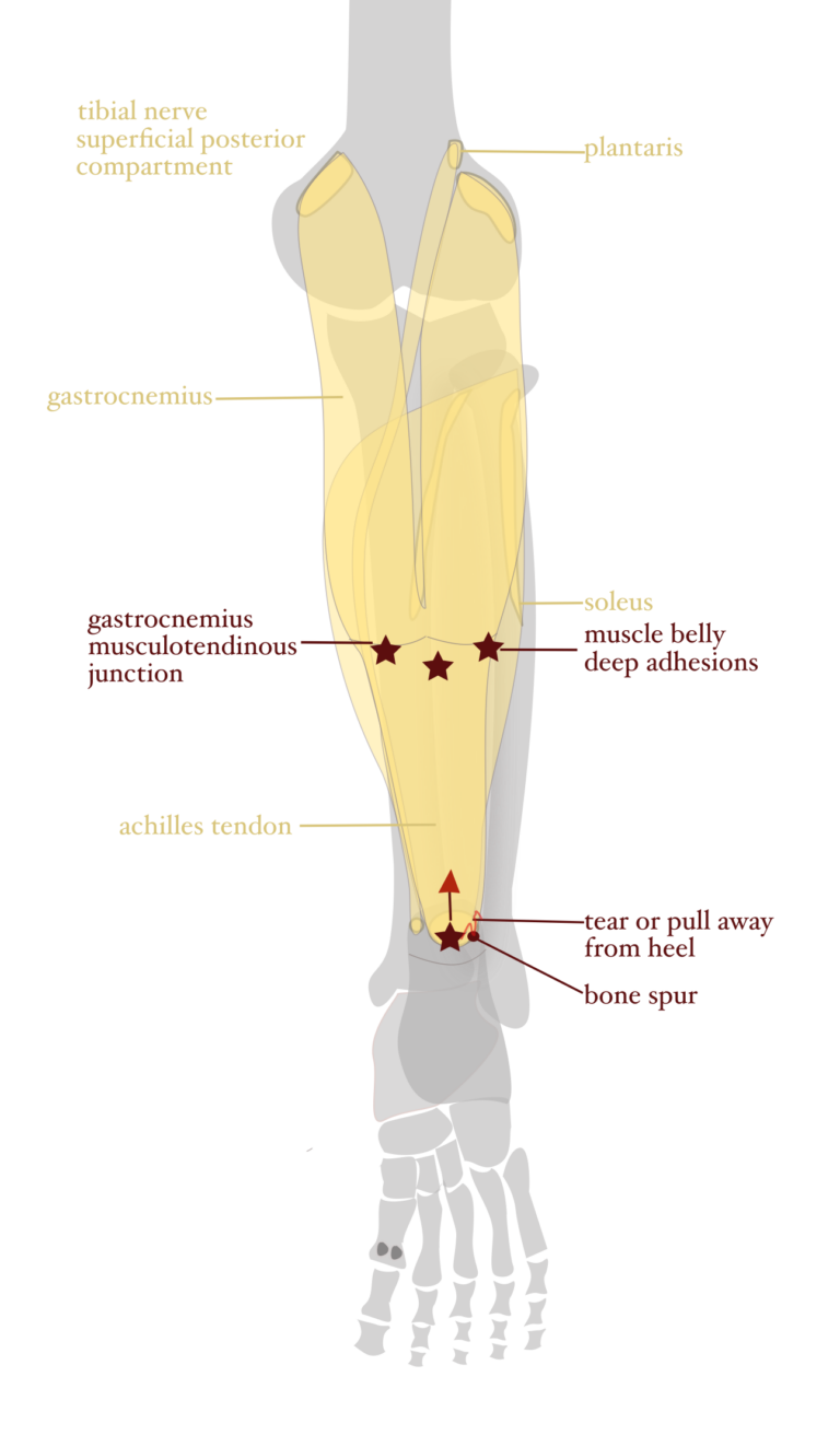 Achilles Tendon Pain | AnatomyFixIt • Clinical, Orthopedic, Sports and ...